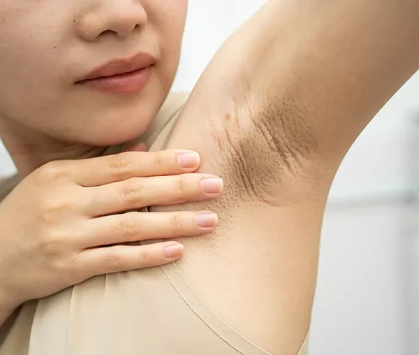 Underarm Whitening Treatment